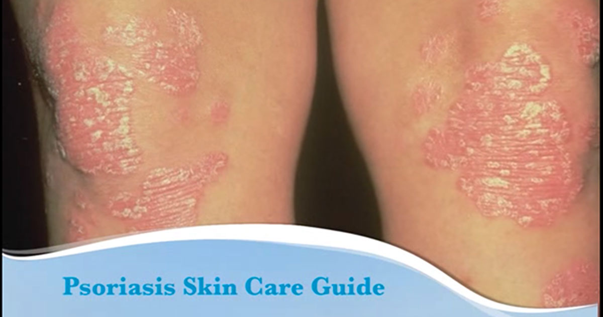 [VIDEO] Skin Care Tips for Psoriasis