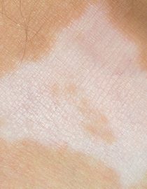 Psoriasis White Patches: What Happens to Your Skin During a Flare-Up?